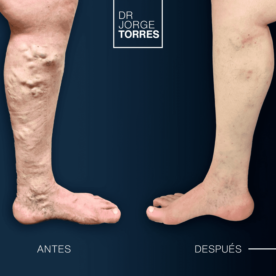 Cirugía de Varices con Láser