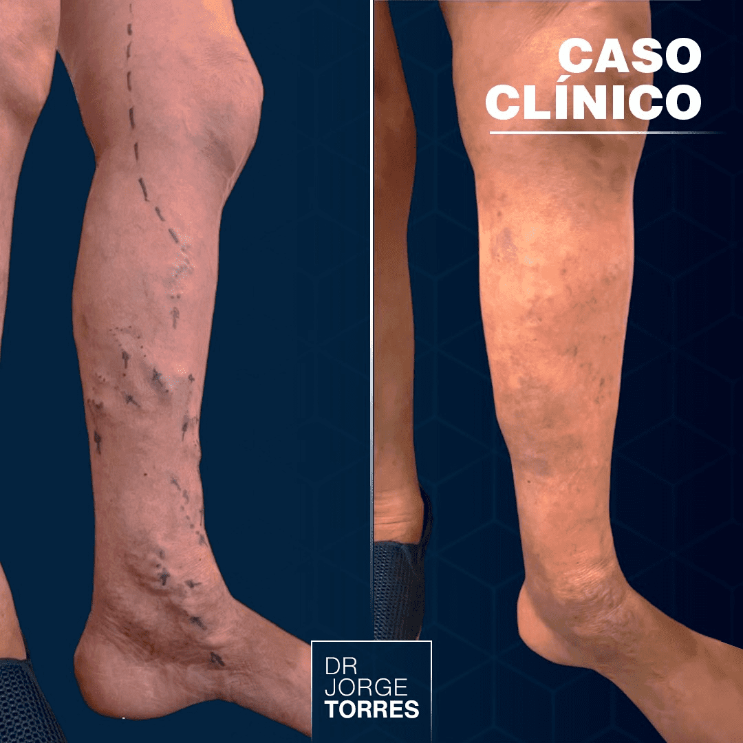 Cirugía de Varices con Láser
