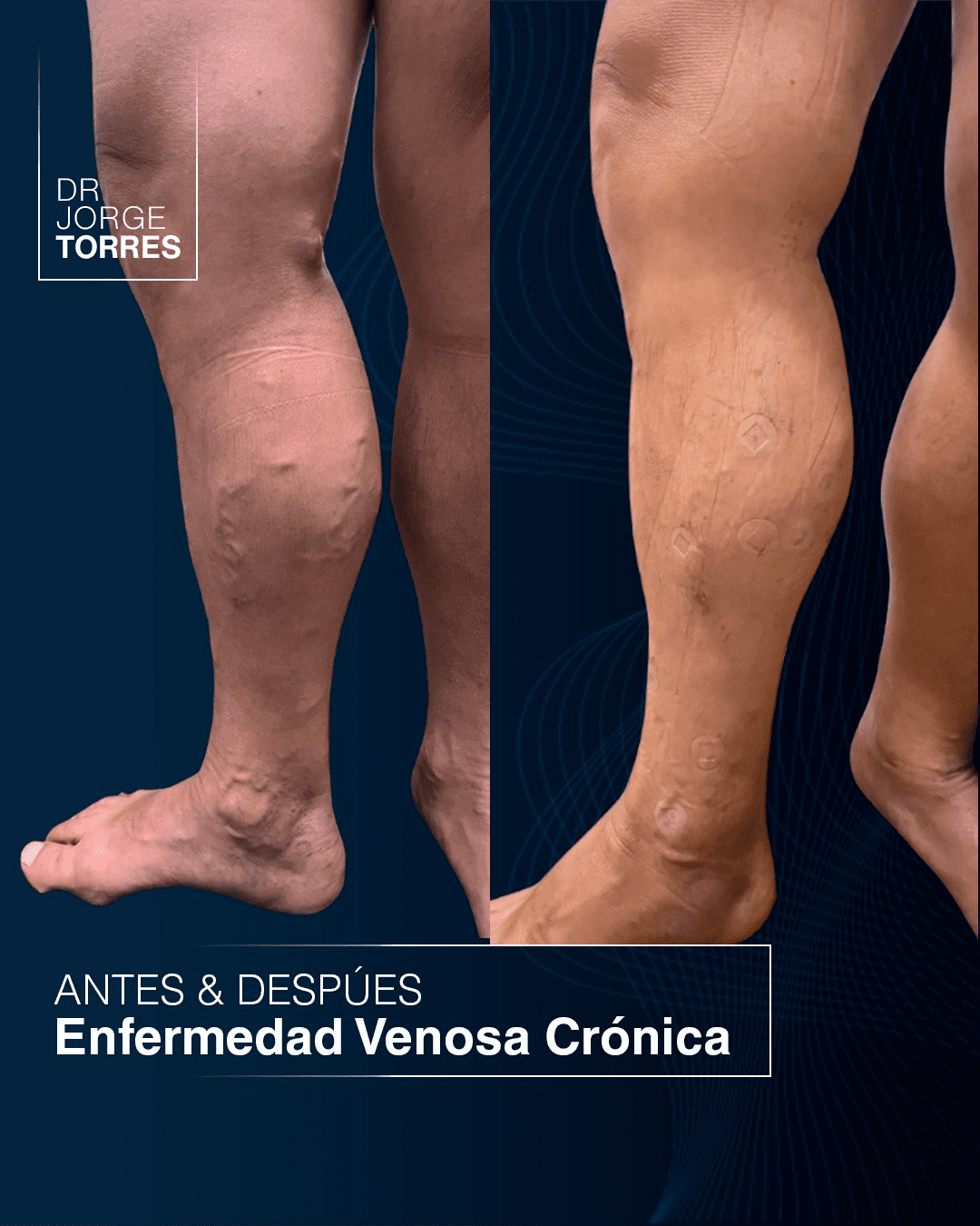 Cirugía de Varices con Láser